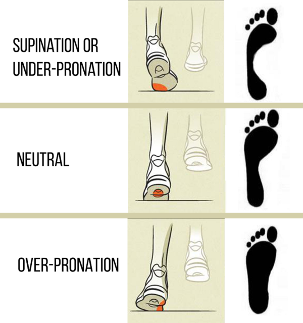 Pronation là gì? Cần chọn giày thể thao tương ứng như thế nào?